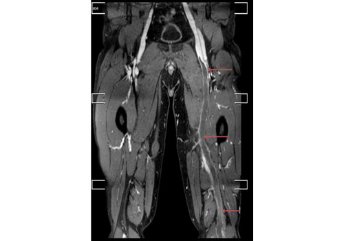 Deep Vein Thrombosis (DVT)