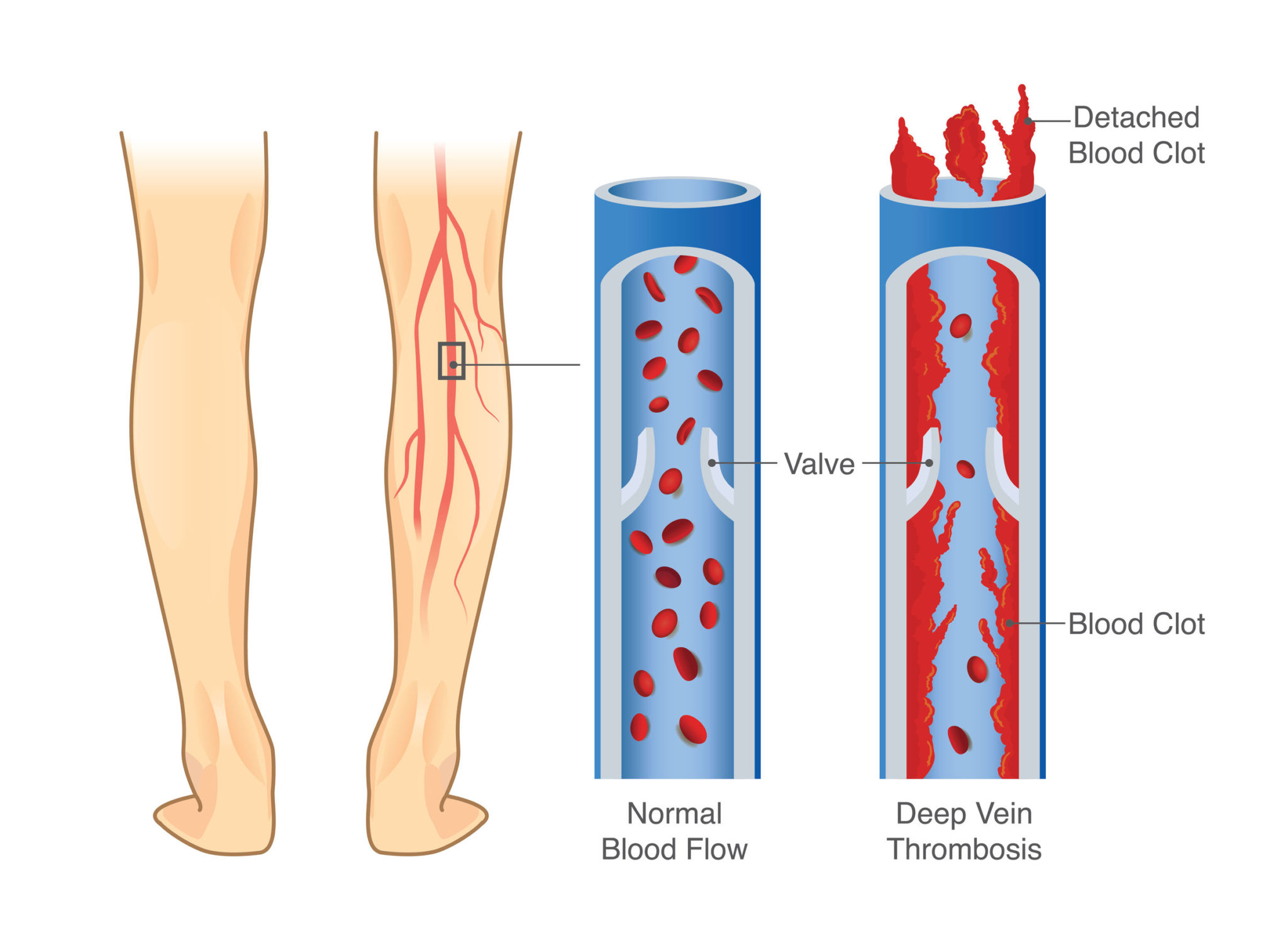 Deep Vein Thrombosis (DVT) - Dr. Sravan